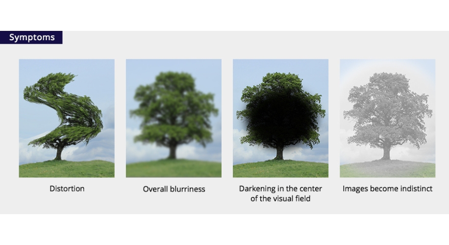 Understanding Visual Field Loss Common Causes Zenni Optical Blog Understanding Visual Field Loss Common Causes Zenni Optical Blog